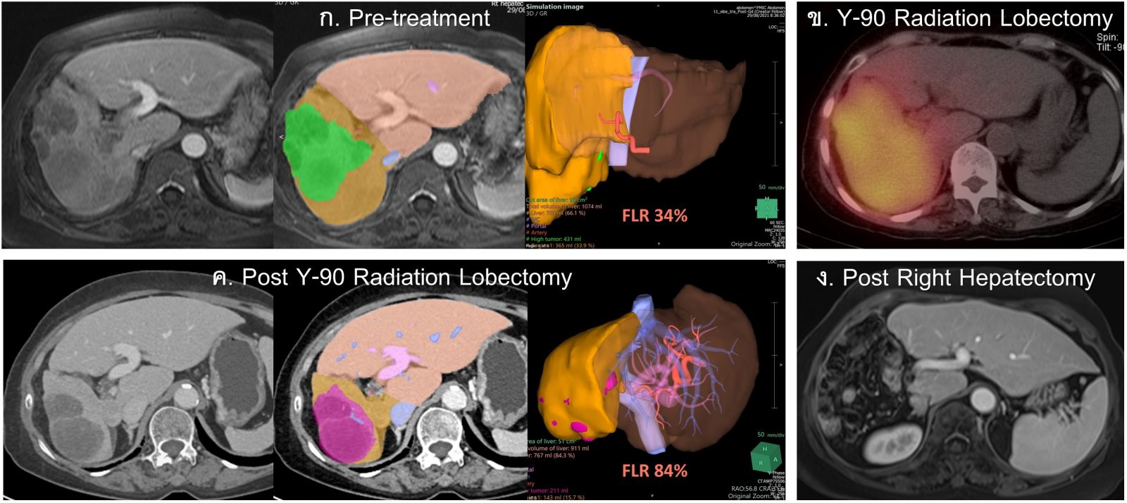 Locoregional Treatment of Hepatocellular Carcinoma – สมาคมโรคตับแห่ง ...